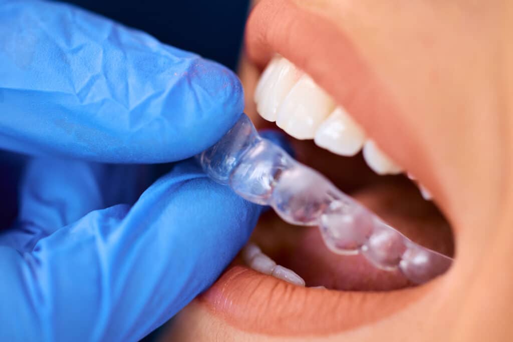 Is Invisalign Covered by Insurance? A Guide to Costs & Coverage ...